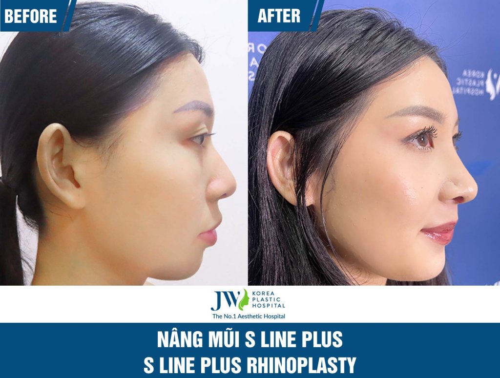 S-Line Plus Rhinoplasty: A Natural Approach to Nose Enhancement