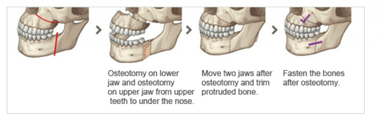 DOUBLE JAW SURGERY - CHANGE YOUR FACE | JW Korea Plastic Hospital