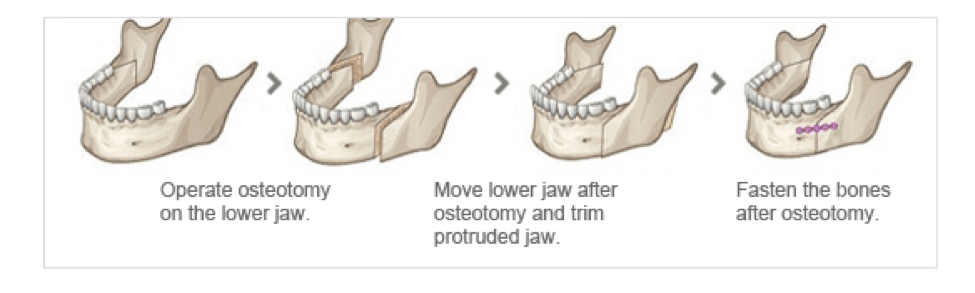 DOUBLE JAW SURGERY - CHANGE YOUR FACE | JW Korea Plastic Hospital
