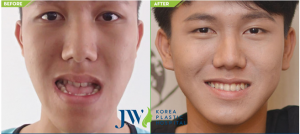 DOUBLE JAW SURGERY - CHANGE YOUR FACE | JW Korea Plastic Hospital