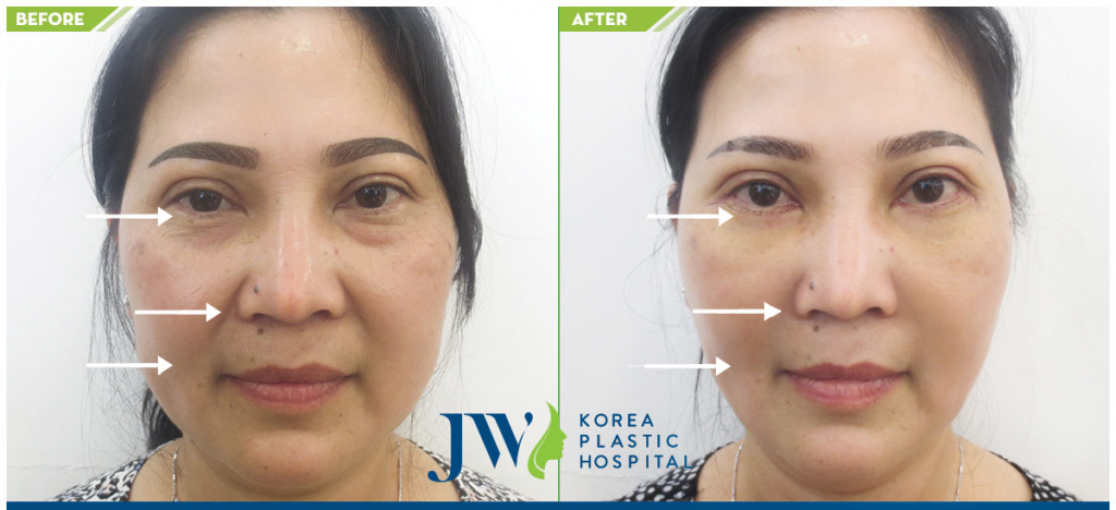 Midface 3 in 1 The best solution for facial | JW Korean Plastic Hospital