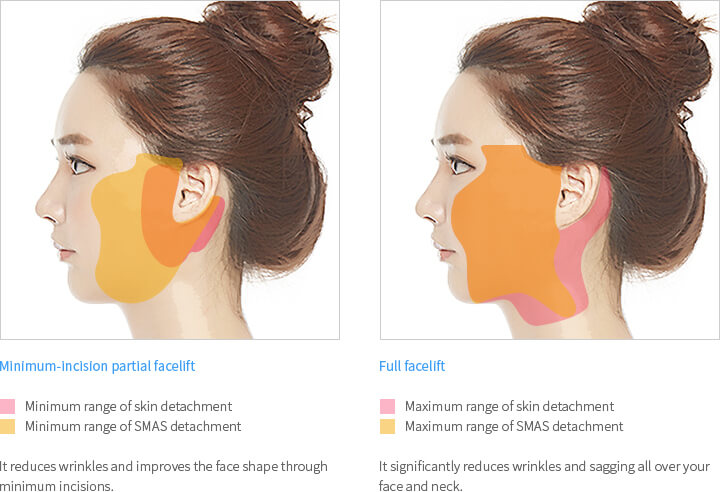 Rejuvenate your skin with just one SMAS facelift treatment